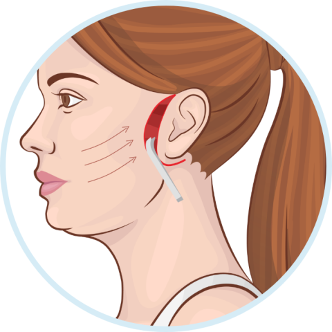 Facelift in Turkey, Istanbul & Facelift Surgery Procedure