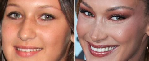 Celebrities Who Have Had Blepharoplasty Before and After