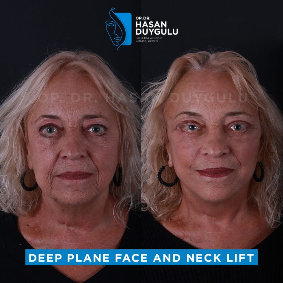 Facelift in Turkey, Istanbul & Facelift Surgery Procedure