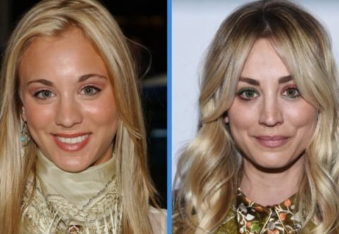 Celebrities Who Have Had Rhinoplasty | Before & After
