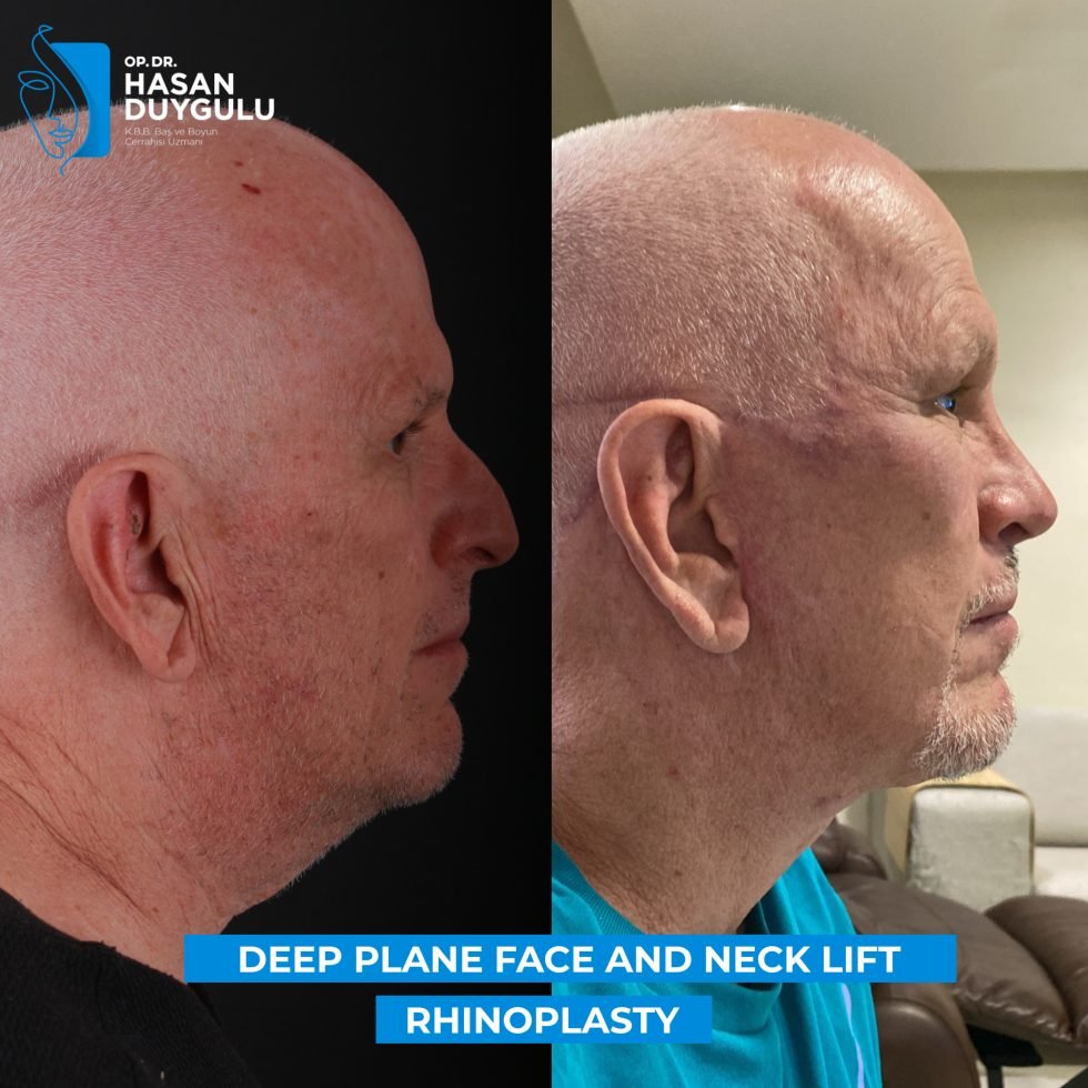 Facelift in Turkey, Istanbul & Facelift Surgery Procedure