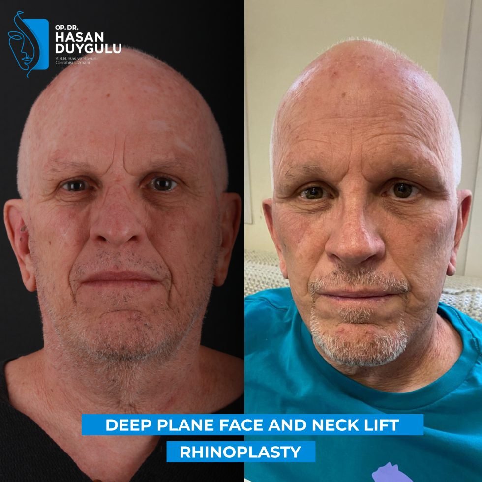 Facelift in Turkey, Istanbul & Facelift Surgery Procedure