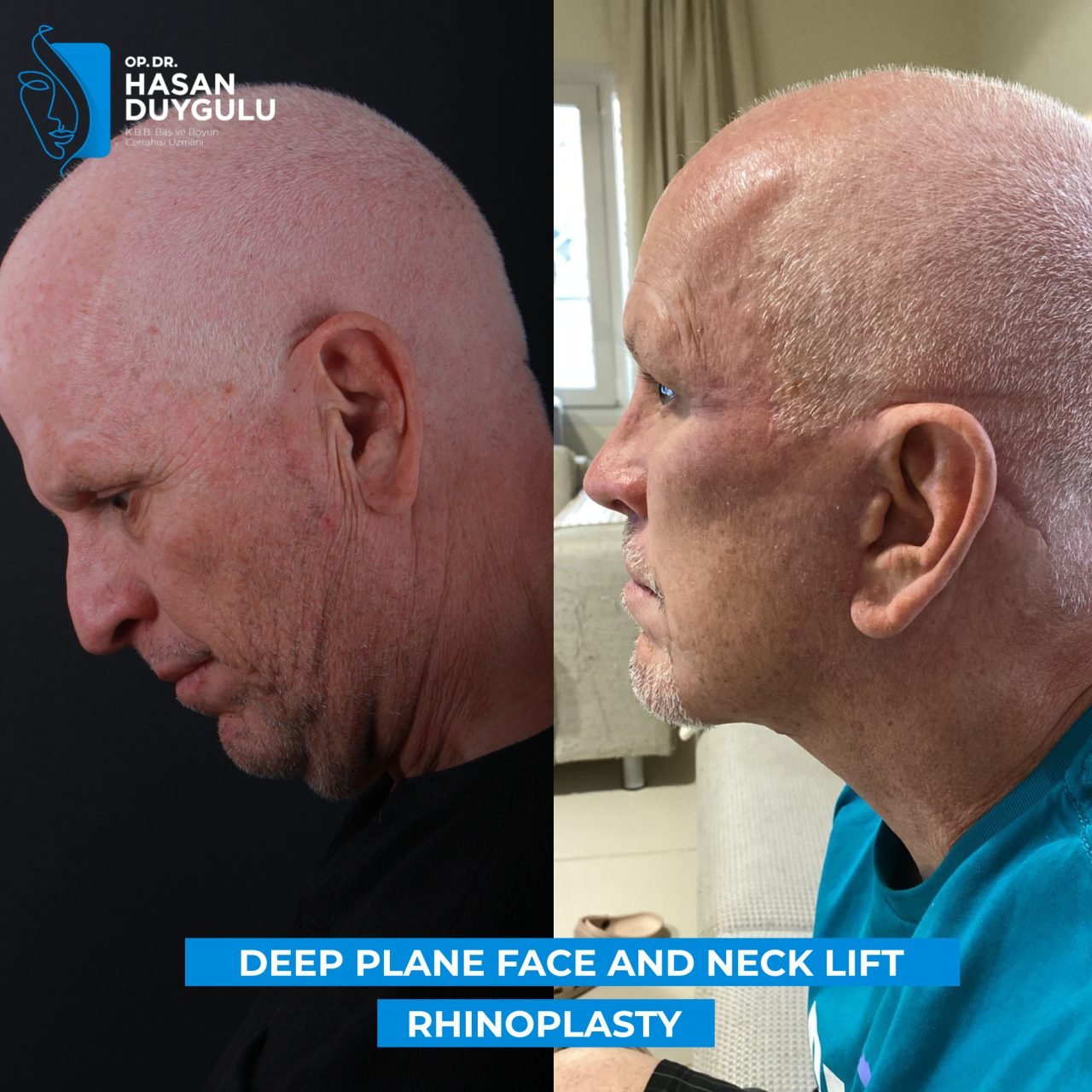 Facelift in Turkey, Istanbul & Facelift Surgery Procedure