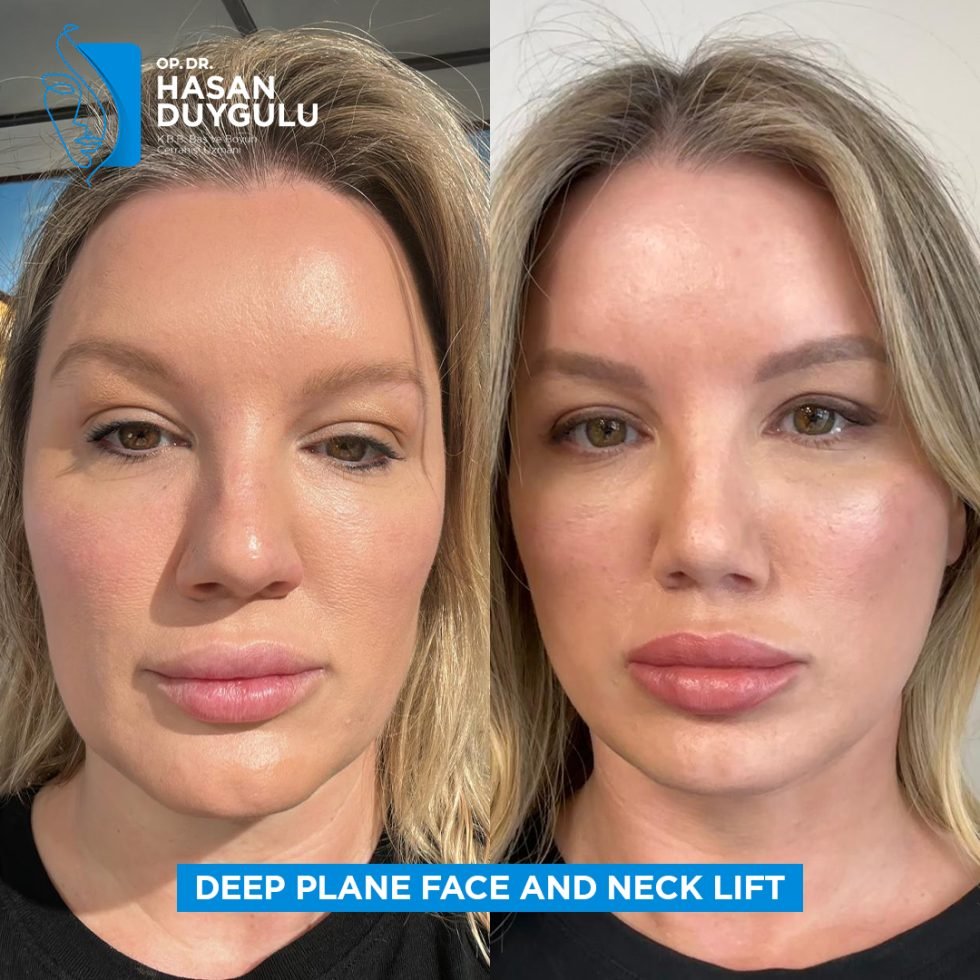 Facelift in Turkey, Istanbul & Facelift Surgery Procedure
