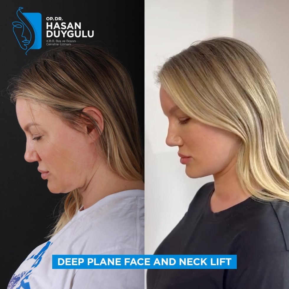 Facelift in Turkey, Istanbul & Facelift Surgery Procedure