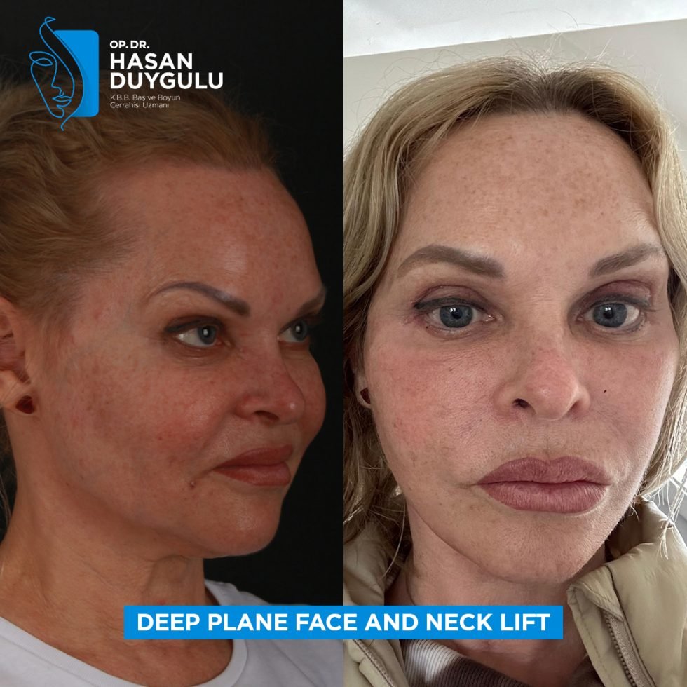 Facelift in Turkey, Istanbul & Facelift Surgery Procedure