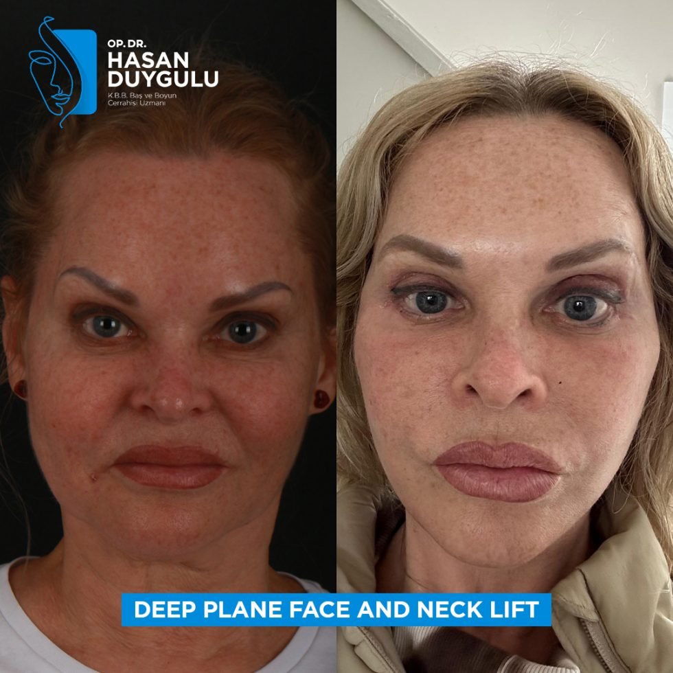 Facelift in Turkey, Istanbul & Facelift Surgery Procedure