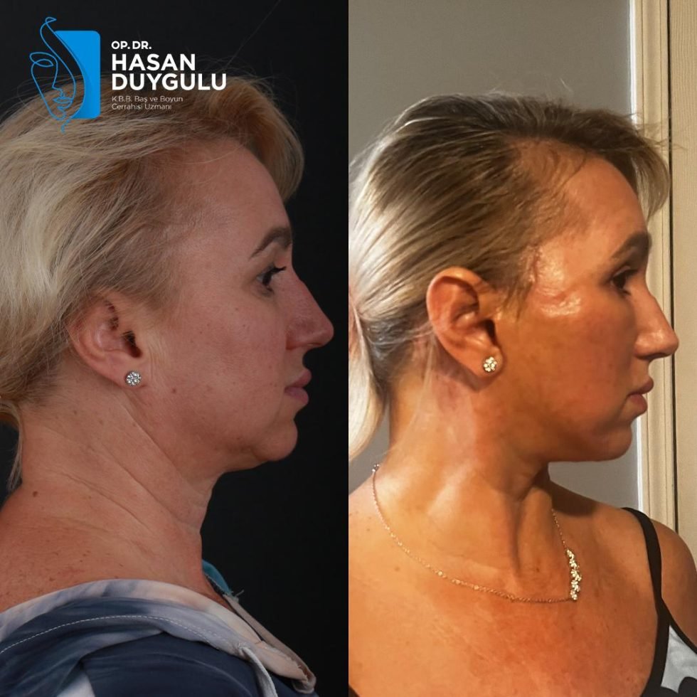 Facelift in Turkey, Istanbul & Facelift Surgery Procedure