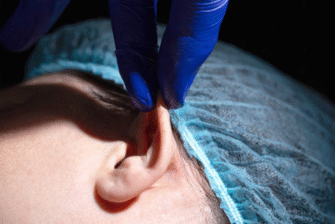Otoplasty Scarring: Will Ear Surgery Leave Visible Scars?