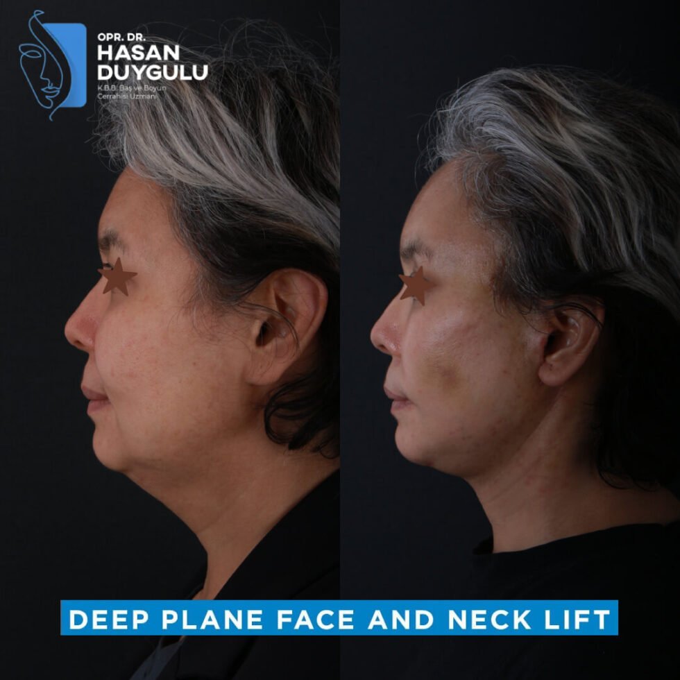 Facelift in Turkey, Istanbul & Facelift Surgery Procedure